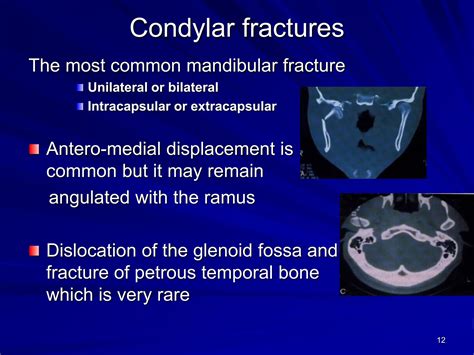 268307418 Management Of Mandibular Fractures Ppt Ppt