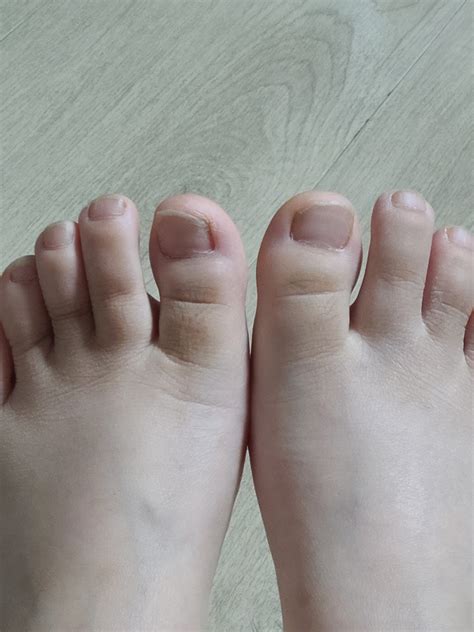 발가락 인대 늘었났다고 하는데 통증이 심합니다 ㅣ 궁금할 땐 아하