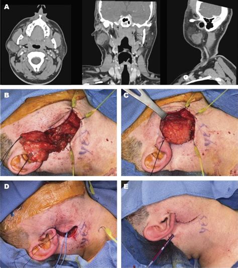 Parascapular Adipofascial Free Flap For Post Parotidectomy