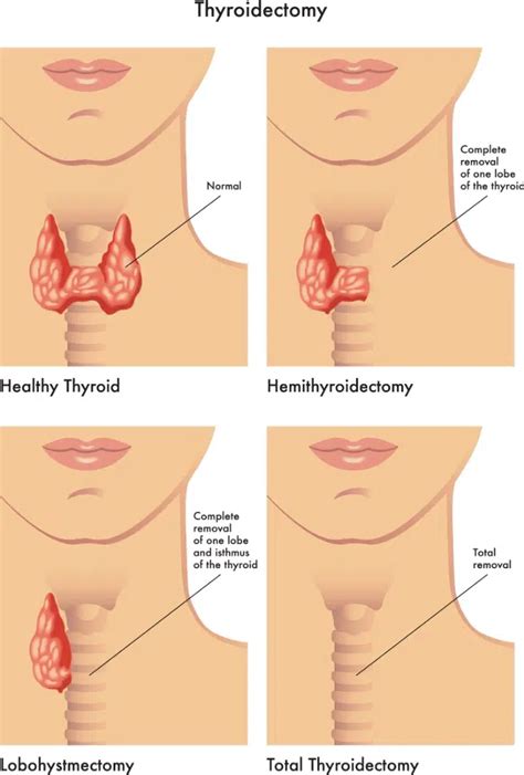 Lump On Neck Left Side