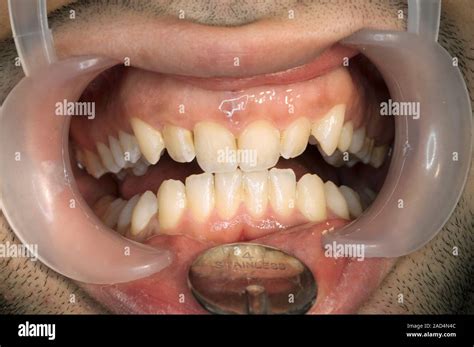 Traumatic Overbite Close Up Of The Mouth Of A 23 Year Old Man With Mandibular Retrognathism A