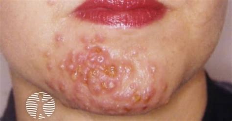 Pyoderma Faciale Rosacea Fulminans Image