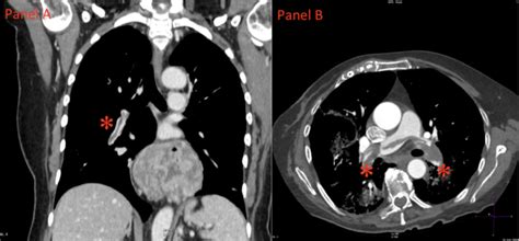 Localization Of Pulmonary Embolism And Pneumonia A B Computed Download Scientific Diagram