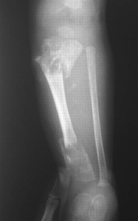 Non Vascularised Fibular Transfer In The Management Of Defects Of Long Bones After