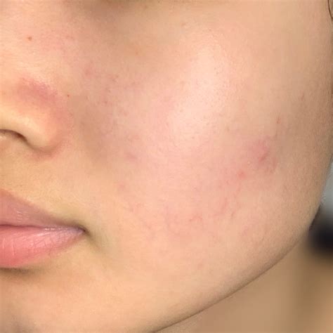 여드름and피부 진정 케어🌱 뷰티팁 By 젱님 언니의파우치