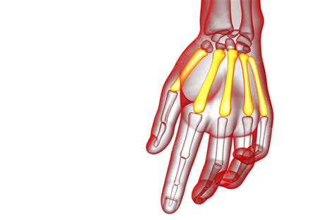 Metacarpal Bone Illustrated Through 3d Rendering In Phalanges Joint Osteoarthritis Png