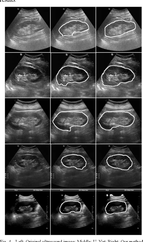 Figure 2 From Renal Ultrasound Image Segmentation Based On U Net And Generative Adversarial Nets