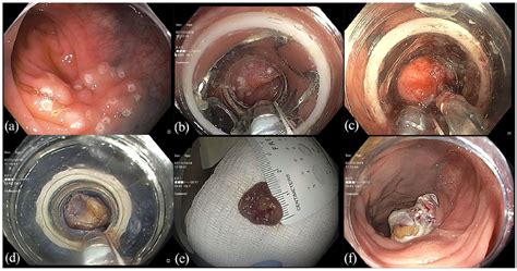 Endoscopic Full Thickness Resection Of Suspected Residual High Grade