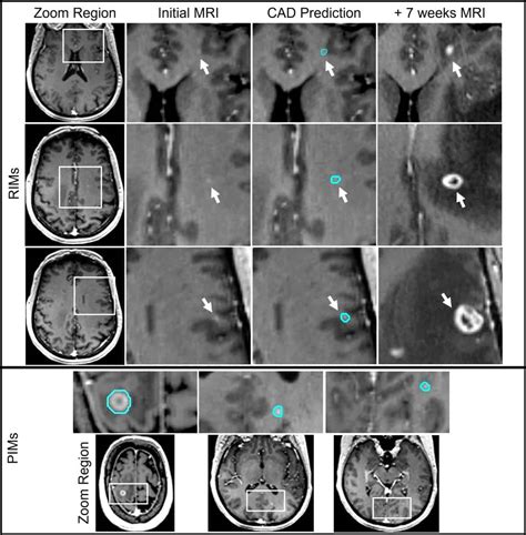 Deep Learning System Identifies Difficult To Detect Brain Metastases