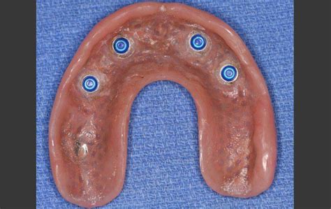 Implant Overdentures After Extractions Male Dental Implant Center