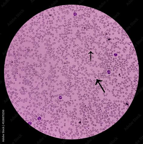 Blood Smear Show Target Cell And Spherocytes Hereditary Spherocytosis