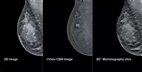 I View® Contrast Enhanced Imaging Cem Hologic® Australia