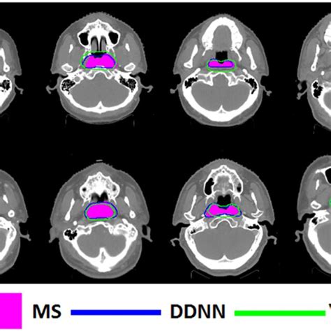Segmentation Results For Nasopharynx Gross Tumor Volume Shown In Download Scientific Diagram