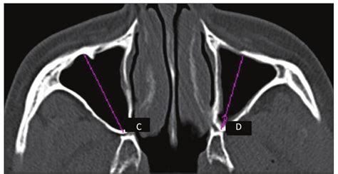 Figure 4 Sex Determination Using Maxillary Sinus