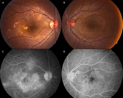 Color Fundus Photography Initial Manifestation Radiation Maculopathy