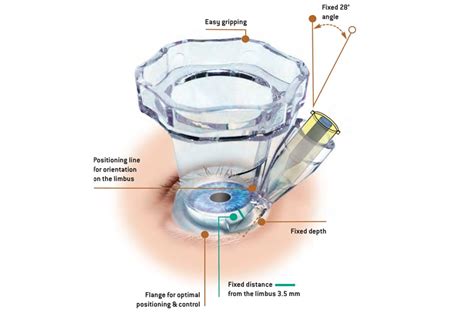 Precivia Intravitreal Device Mivision