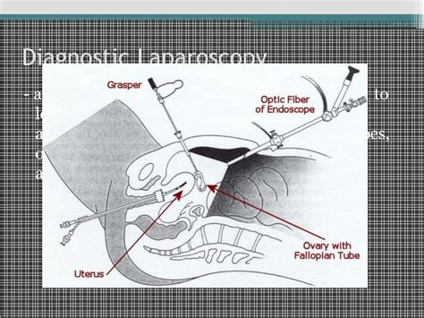 Ppt Diagnostic Laparoscopy Powerpoint Presentation Free Download Id 2275901