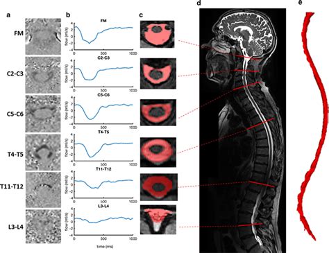 Subject Specific Example Of Csf Flow And Geometric Reconstruction For Download Scientific