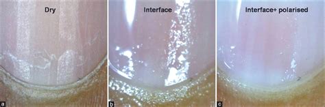 Onychoscopy A Practical Guide Indian Journal Of Dermatology
