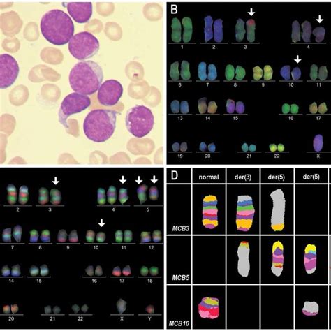 A Early T Cell Precursor ALL Cells Of The Presented Patient Depicted Download Scientific