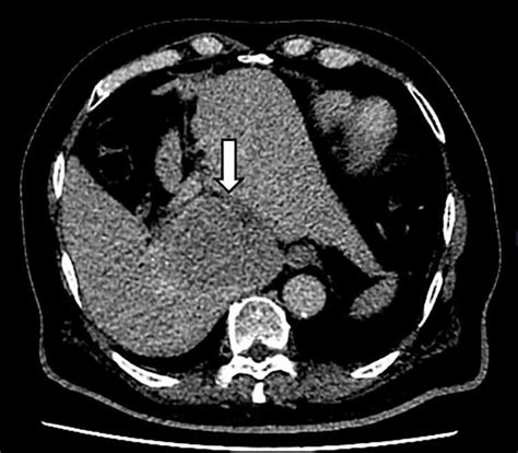 Ct Scan Axial Section Delayed Phase Showing A 32 × 30 Cm Lesion