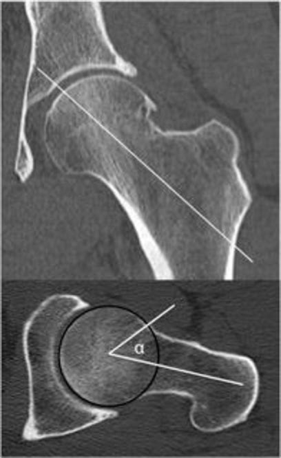 Figure 1 From Discrete Mineralisation Of The Acetabular Labrum A Novel Marker Of