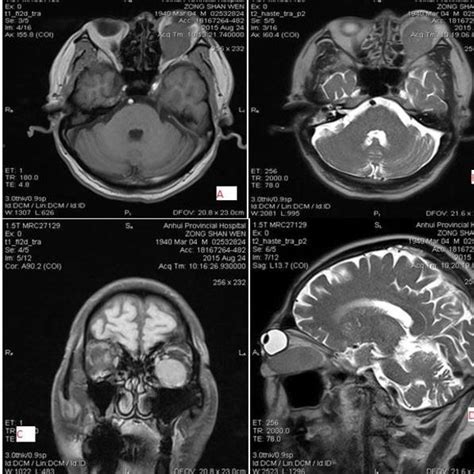 39 Years Old Female With Left Sided Inflammatory Pseudotumor Located
