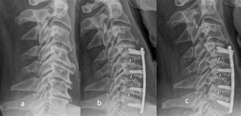 C3 C5 Spinal Fusion