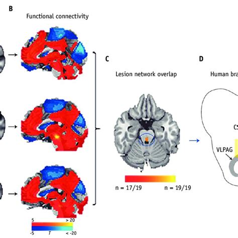Lesion Network Mapping Of Rapid Eye Movement Sleep Behavior Disorder Download Scientific