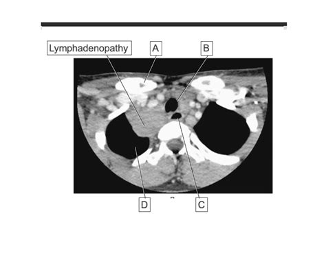 Thoracic Anatomy Ct 22 Quiz
