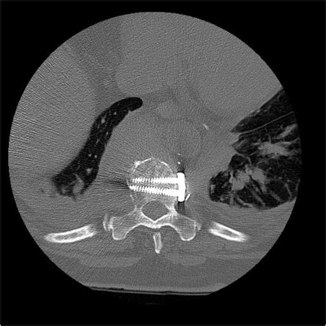 Thoracotomy For Exposure Of The Spine Ctsnet