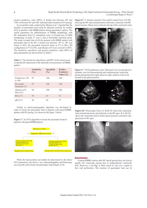 Right Bundle Branch Block Morphology After Right Ventricular Endocardial Pacing PDF