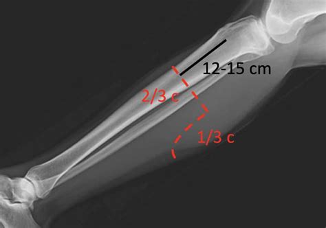 Amputation The Operative Review Of Surgery