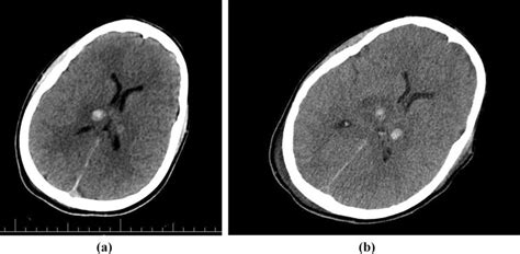 A Ct Scan Of The Brain At The Er Showing Two Hyperdense Lesions In The
