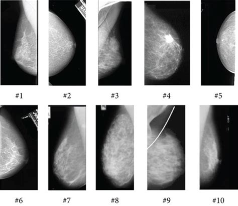 Some Examples Of The Mias Database Mammography Images Download