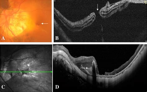 Macular Hole Formation After Intravitreal Conbercept Injection Three Download Scientific