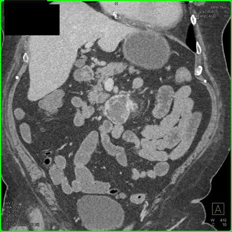 Duodenal Gist Tumor Small Bowel Radiology Case Studies Ctisus Ct