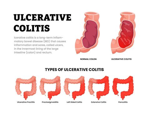Different Types Of Ulcerative Colitis Types Labeled Ulcerative