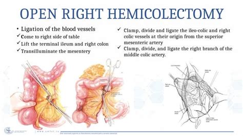 Open Right Hemicolectomy General Surgery Coursepptx