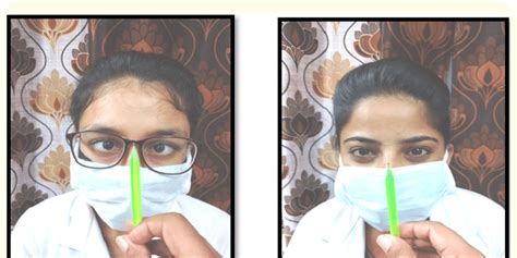 The Patient Showing Convergence A Normal Npc B Patient Having