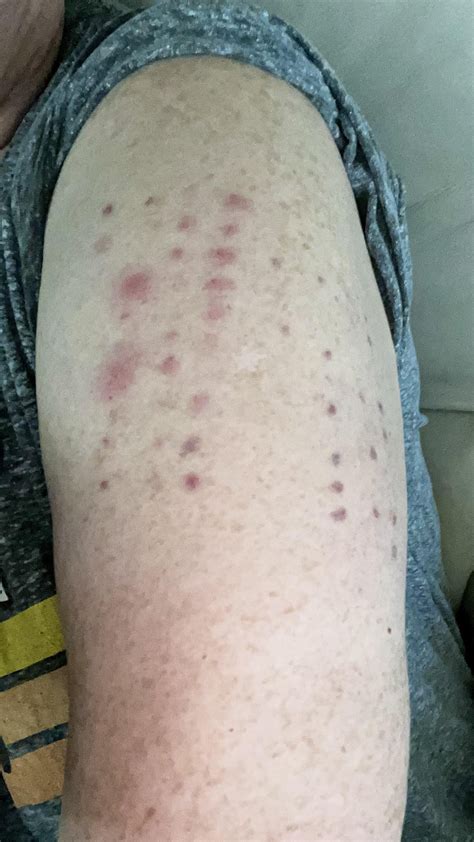 Allergy Testing Rallergy
