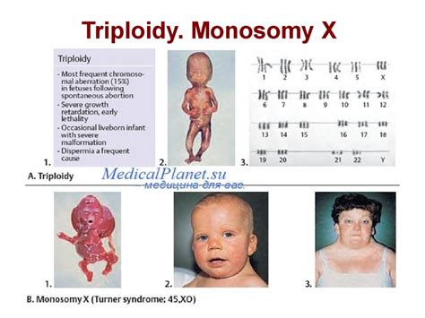 Complete Triploidy At Edna Weiss Blog