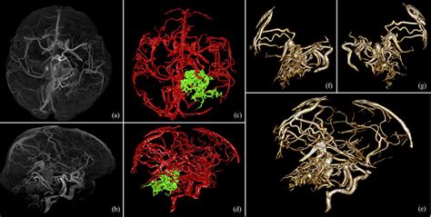 Performances Of Cerebrovascular Segmentation From Tof Mra With Avm Download Scientific Diagram