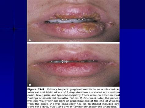 Infection Of Oral Mucosa Ppt