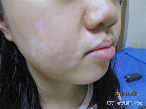 我的白癜风已经好了，给大家信心 知乎