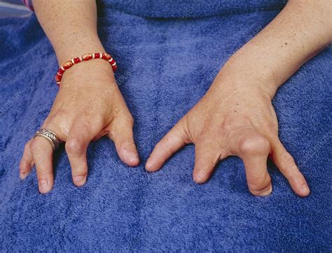 Ectodermal Dysplasia Stock Image M150 0212 Science Photo Library