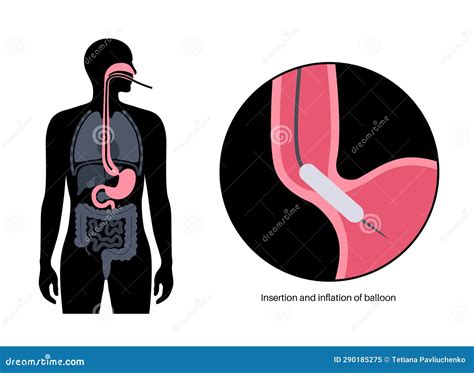 Esophageal Dilation Procedure Cartoon Vector 226754915