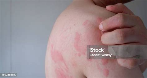 심한 알레르기를 앓고 있는 피부 질감의 이미지를 닫습니다 두드러기 피부 상태에 대한 스톡 사진 및 기타 이미지 두드러기 피부
