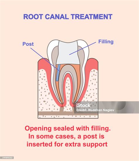 근관 치료 인포그래픽 치과 및 구강학 건강 관리 및 의학 의학 교육 자료 평면 벡터 일러스트 레이 션 건강관리와 의술에 대한 스톡 벡터 아트 및 기타 이미지 Istock