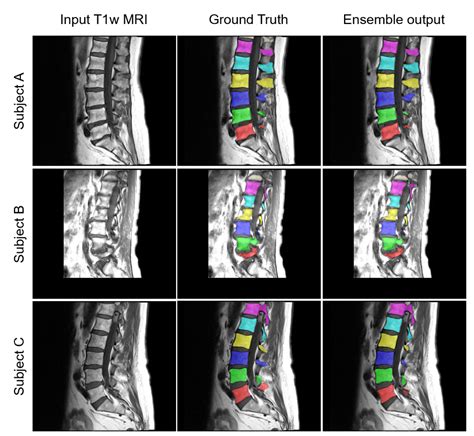 Developing Custom 3d Medical Image Segmentation Solutions Using Out Of
